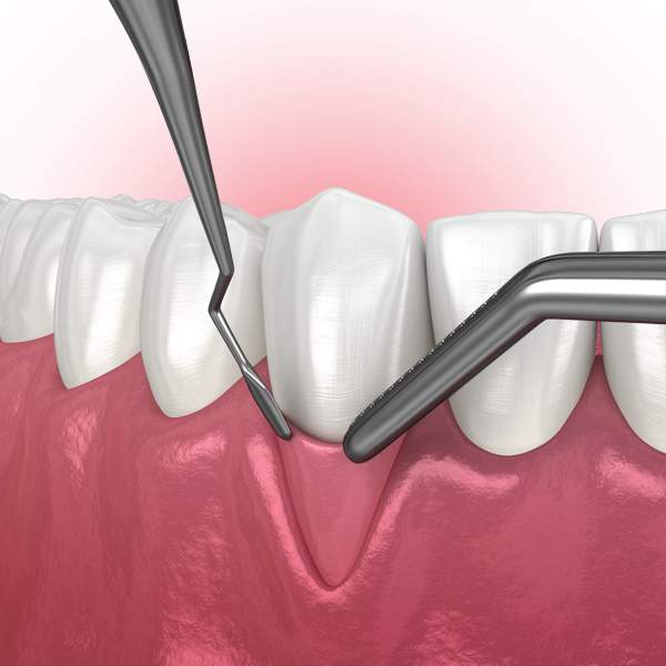 Periodontist Kingston ON | Periodontics | Limestone Periodontics